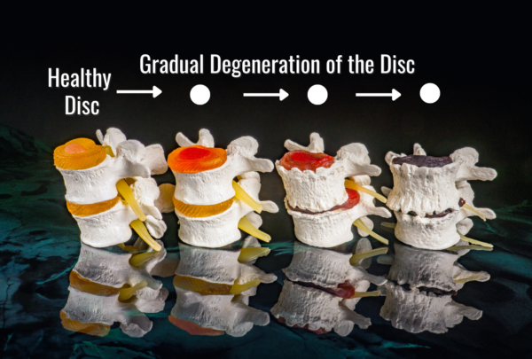 Degenerative Disc Disease Explained