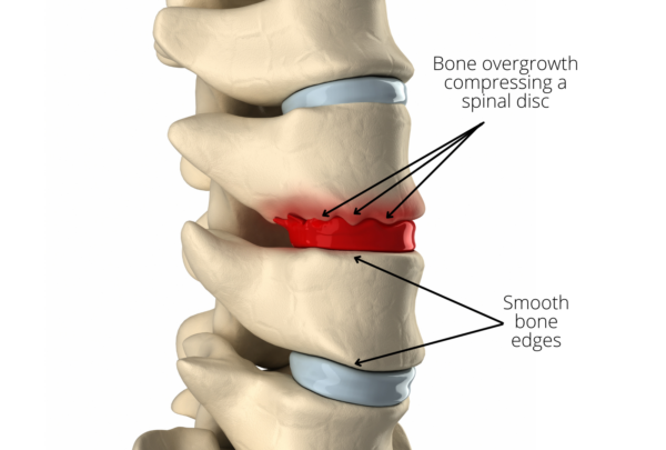 What is a Bone Spur? Causes and Symptoms of Lumbar Osteophytes