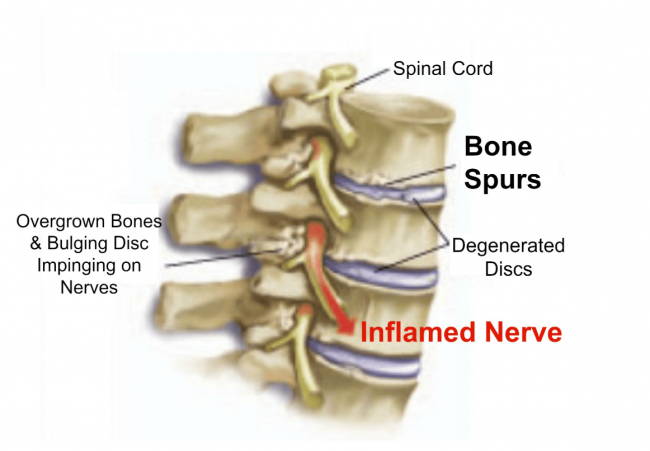 symptoms of lumbar osteophytes Archives - Spinal Back Rack