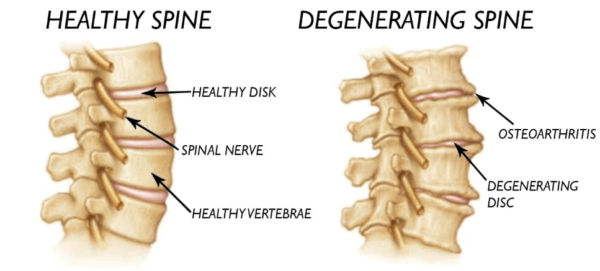 Back Pain and the Ageing Spine | Spinal Backrack System