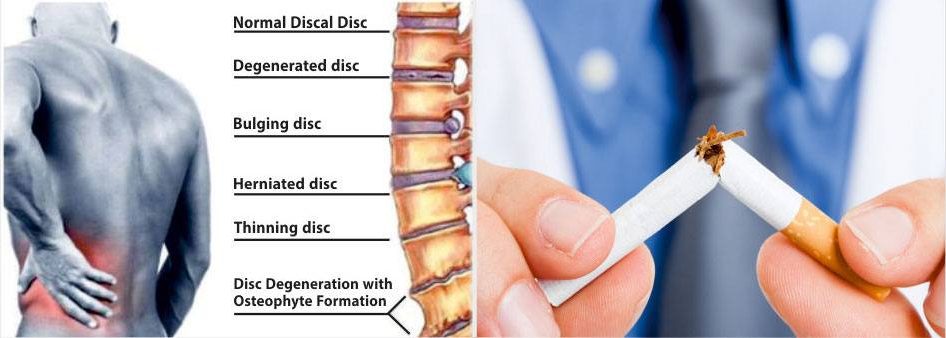 ho to quit smoking Archives - Spinal Backrack