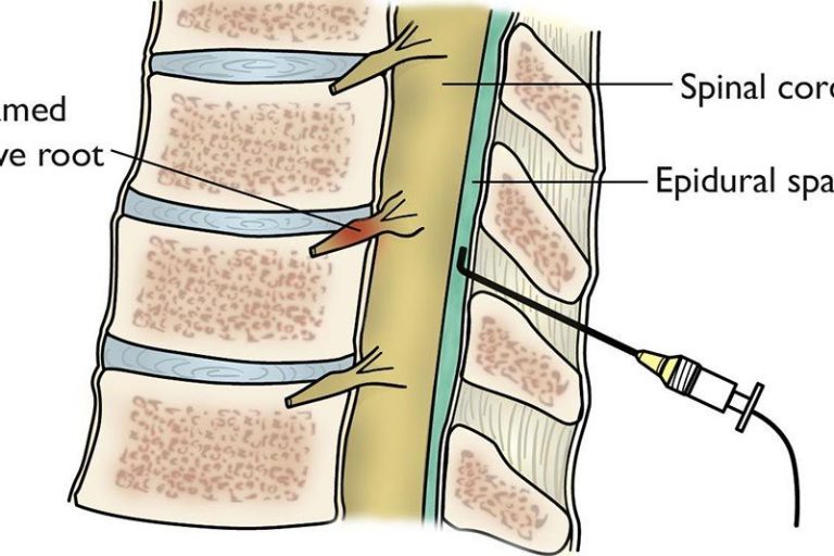 News - Spinal Backrack