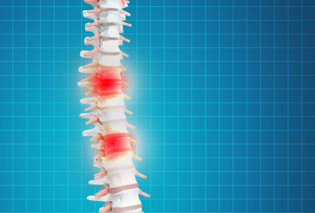 disc problems Archives - Spinal Backrack