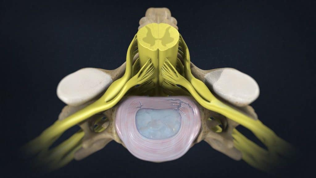 Annular Tearing – How Does It Happen? What Are Treatment Options ...