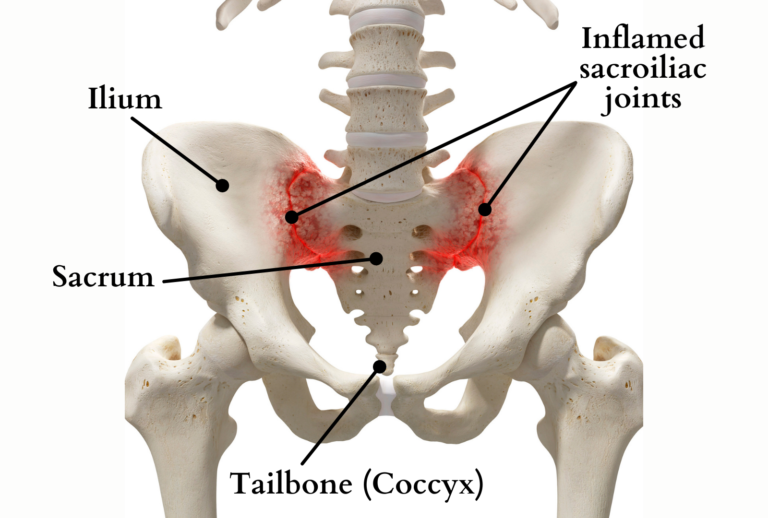 Sacral Bone Pain: Causes and Relief