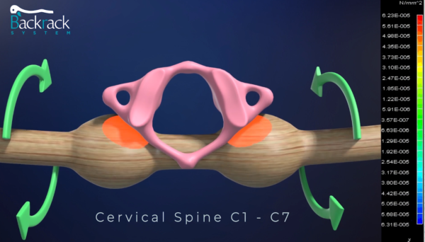 Cervical Kyphosis - Causes, Symptoms and Treatment - Spinal Backrack