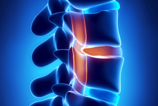 The Effects of Backrack Belt on Lumbar Disc Deformation