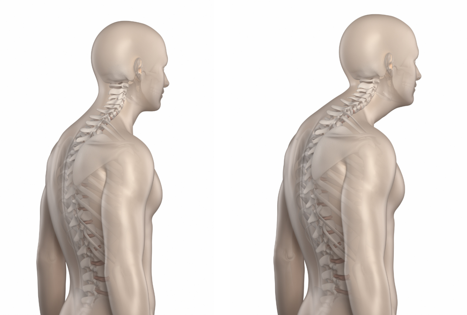 Thoracic Kyphosis Types, Causes, Symptoms, Treatment