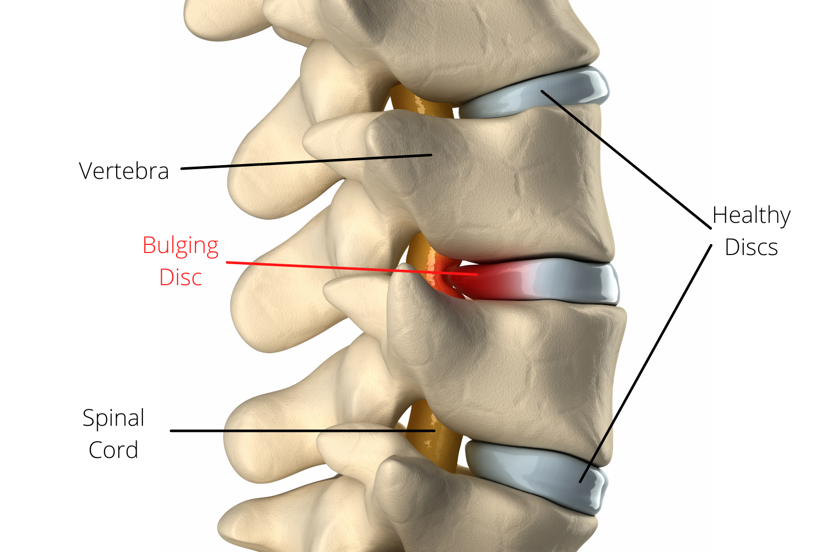 How To Heal A Bulging Disc Naturally Spinal Backrack How To Heal A Bulging Disc Naturally Spinal Backrack
