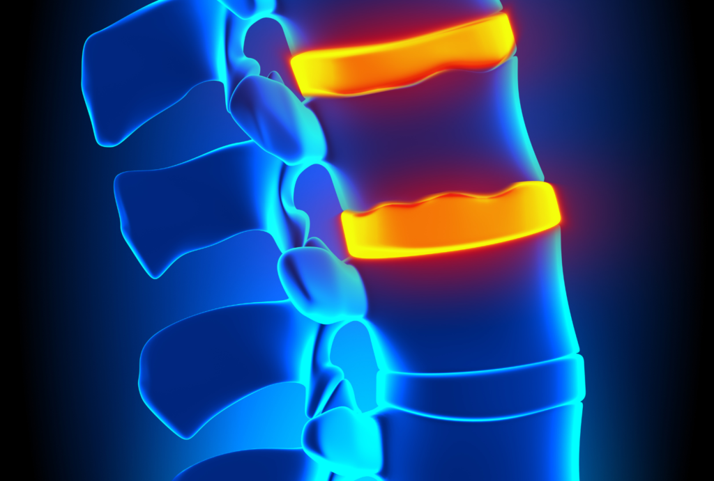 Degenerative Disc Disease Archives - Spinal Backrack