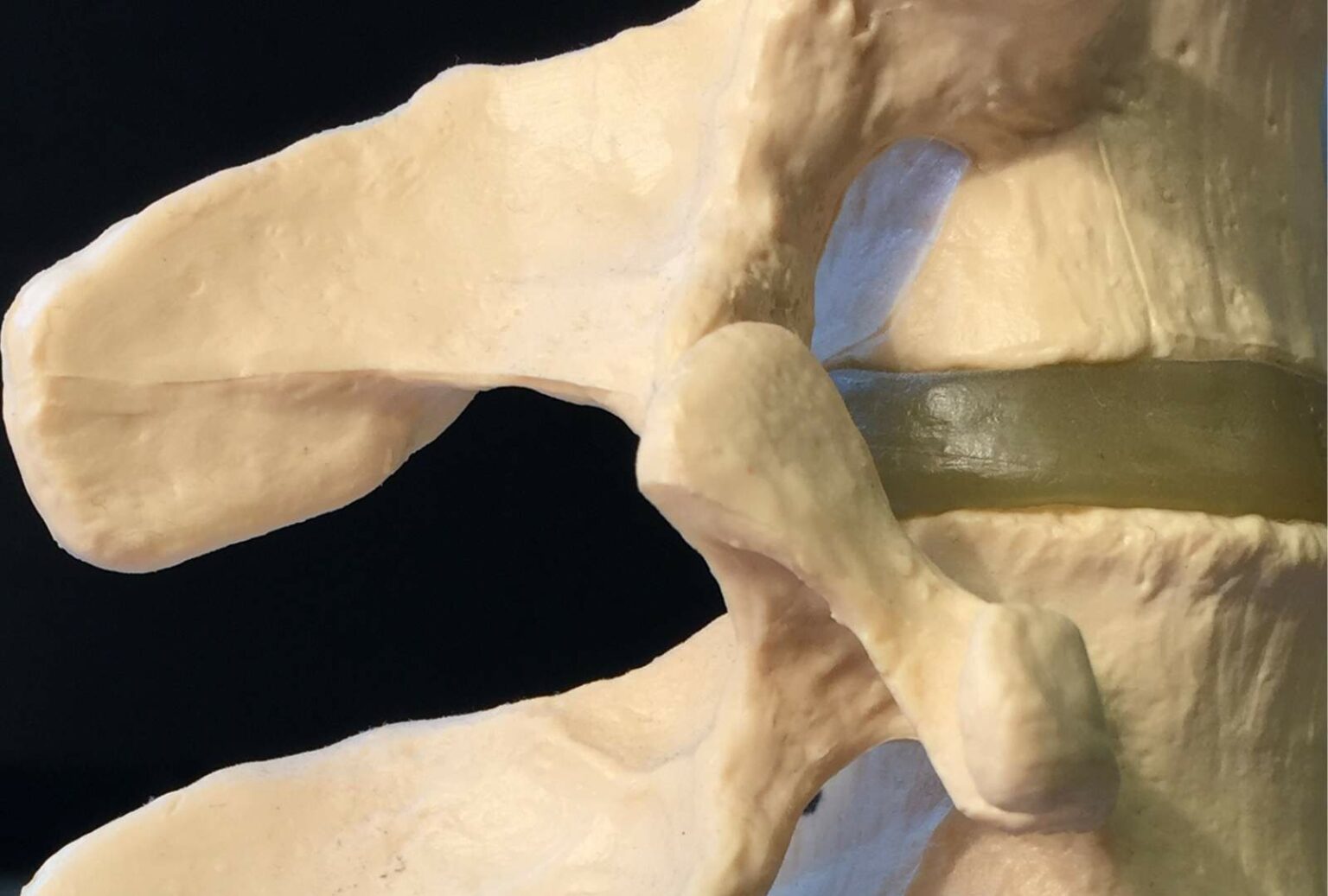 Facet joint syndrome Archives - Spinal Backrack