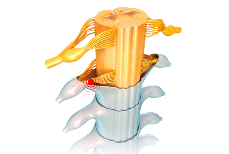 Nerve Impingement Syndrome